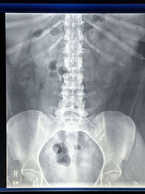 Finally Found My Missing Filshie Clip Album On Imgur