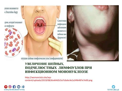 Инфекционный мононуклеоз у детей презентация онлайн