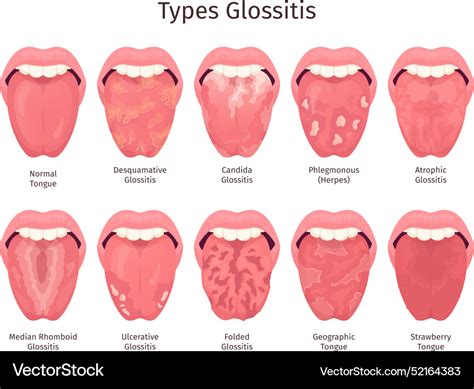 Glossitis Tongue