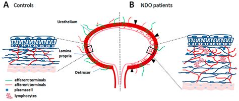 The Botulinum Treatment Of Neurogenic Detrusor Overactivity The Double
