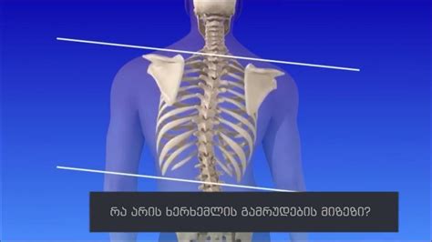 Atlasprofilax In Georgia ატლასპროფილაქსი ხერხემლის მკურნალობა სქოლიოზი