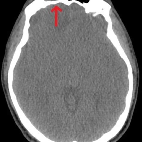 Ct Showing Opacified Right Frontal Sinus Download Scientific Diagram