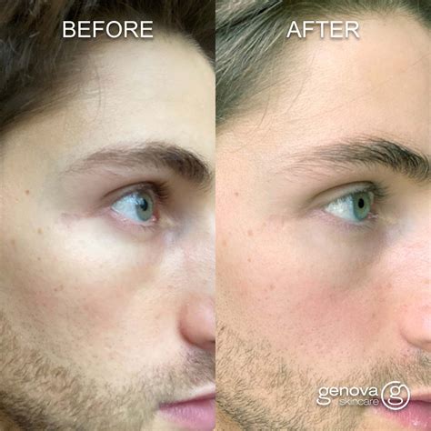 Understanding Different Types Of Scars A Comprehensive Treatment Guid