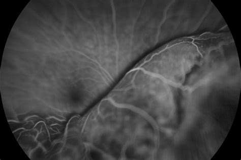 Choroidal Melanoma