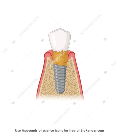 Free Peri Implantitis Icons Symbols And Images Biorender