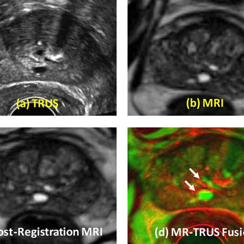The Mr Trus Prostate Registration Diagram The Prostate Gland Is Shown Download Scientific