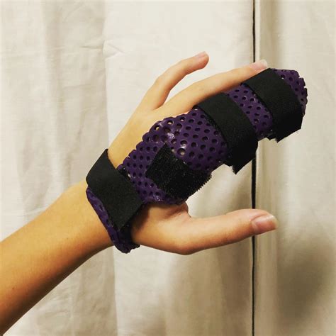 Radial Gutter Splint Pattern