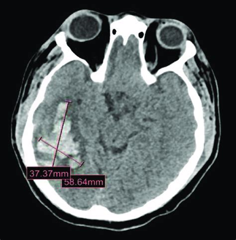 Brain Computed Tomography Ct Scan On Hospital Day 9 Large Hyperdense Download Scientific