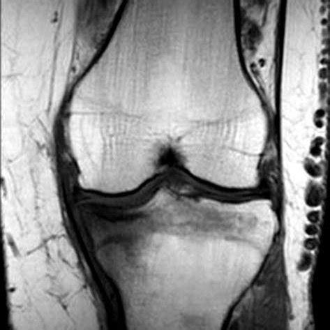 Fracture Of Proximal Tibia Arrow Download Scientific Diagram