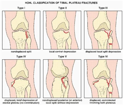 Lower Limb Ii Knee Radiology Key