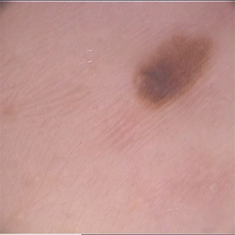 Image Of An Atypical Nevus With Reticular‐homogeneous Pattern And Download Scientific Diagram