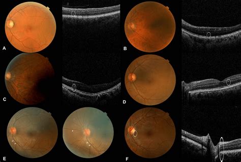 Examples Of False Negative Cases For Hyperreflective Foci On Download Scientific Diagram