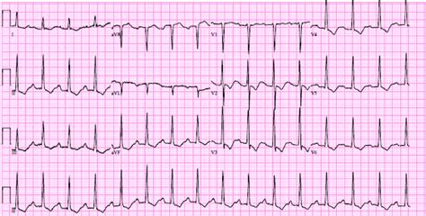 Initial Ecg At Time Of Presentation With K 17 Mmoll Significant