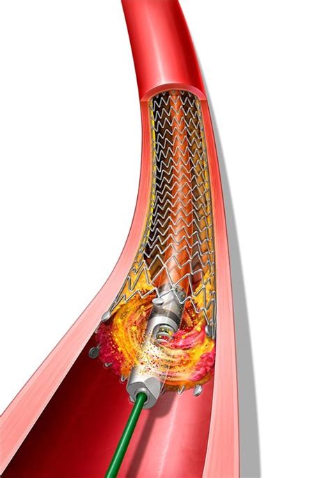 Bd Announces 510 K Clearance Of Expanded Indications For The Rotarex™ Atherectomy System