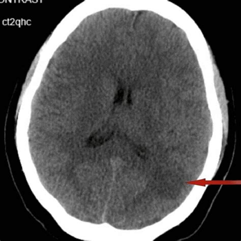 Masslike Rounded Area Of Hypoattenuation In The Posterior Left