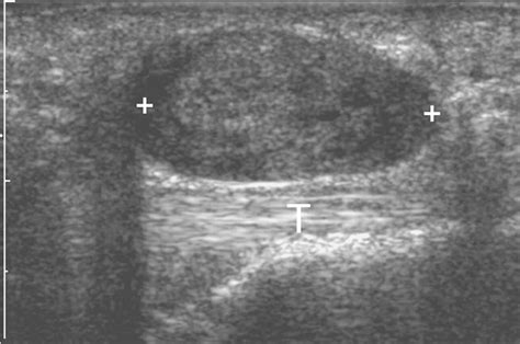 Giant Cell Tumor Of Tendon Sheath Ultrasound