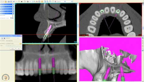 Dental Implant Imaging In Eatontown Nj Dr Marc E Gordon