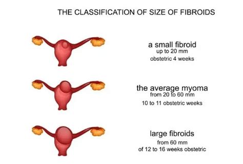 Understanding Fibroid Sizes Usa Fibroid Centers