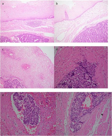 Case 2 Histopathology Of The Primary Tumour A And B Demonstrates