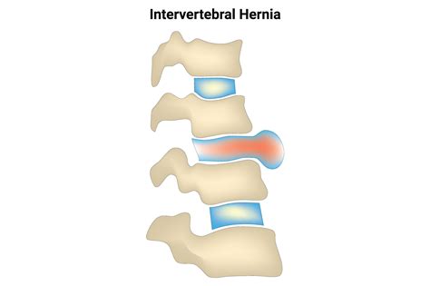 Intervertebral Hernia Science Design Graphic By Hamjaiu · Creative Fabrica