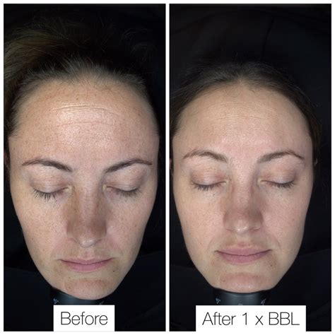 Broadband Light Therapy Bbl Therapy Jade Cosmetic And Wellness Clinic