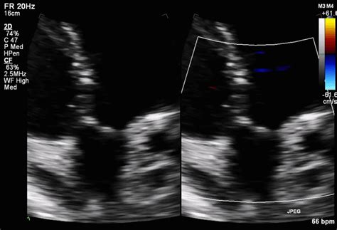 Ventricular Septal Defect Vsd Cardio Guide