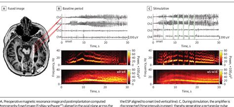 Figure 1 From Association Of Closed Loop Brain Stimulation