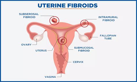 What Is Uterine Artery Embolization Hrh