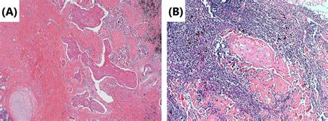 Tumor Cells Morphology Is Shown By Hematoxylineosin Staining A Download Scientific Diagram