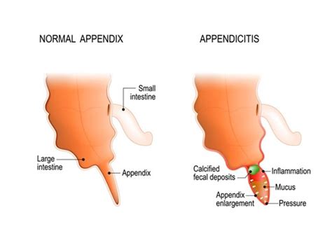 What Does The Appendix Do And Other Questions About The Bodys Mystery Organ