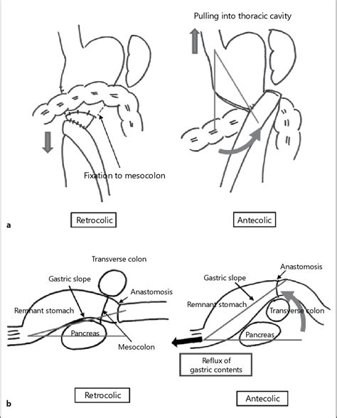 Figure 4 From Retrocolic Or Antecolic Roux En Y Reconstruction After Distal Gastrectomy Which