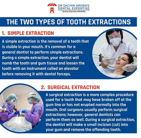 Simple Extraction Vs Surgical Extraction At Ali Lemmone Blog