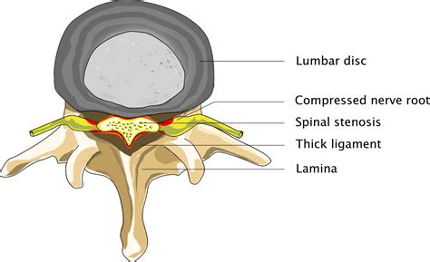 Lateral Recess Anatomy Spinal Stenosis Practice Essentials Anatomy