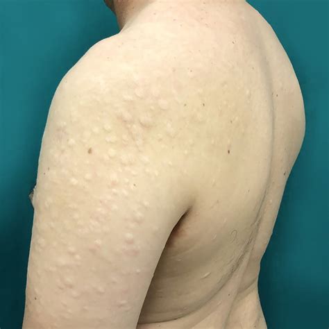 Multiple Hypopigmented Papules With Central Atrophy In The Left Arm
