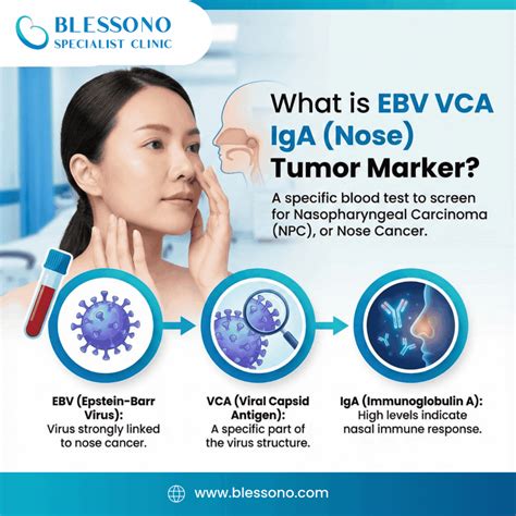 5 Vital Facts About The Ebv Vca Iga Tumor Marker