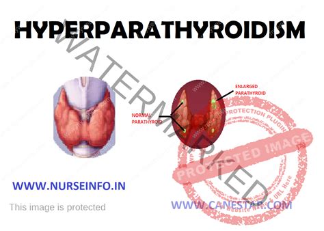Hyperparathyroidism Nurse Info