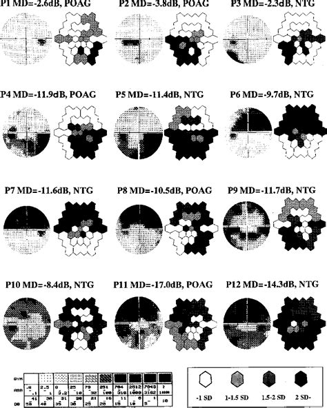 Glaucoma Vision Loss Pattern