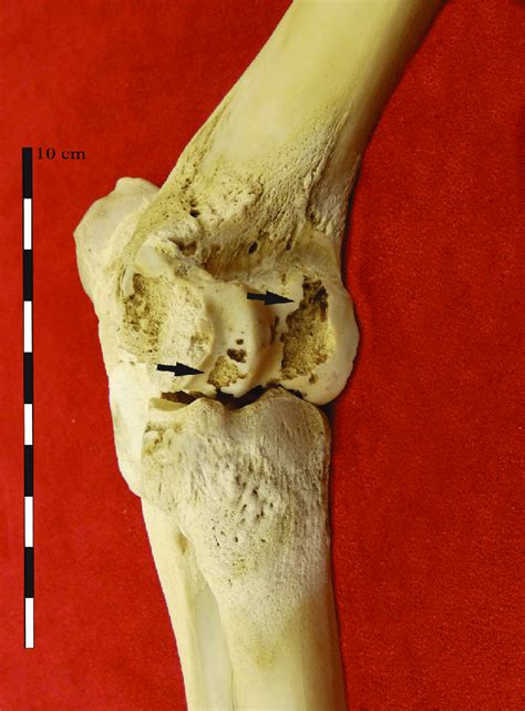 New Bone Growth Lytic Cortical Lesions Marked With Arrows And Bone