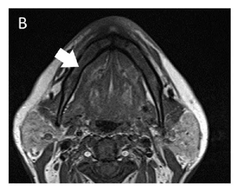 Axial Mri Images At The Level Of The Mandible Demonstrating Abnormal Download Scientific