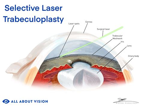 Trabecular Meshwork Key Role In Eye Fluid Drainage