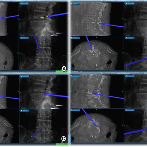 Design Of Intraoperative Skin Incision Assisted By Navigation Download Scientific Diagram
