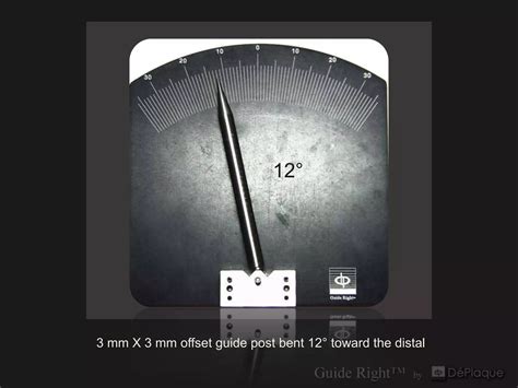 10 3 mm implants in narrow space angular and linear corrections ppt