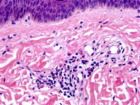 Pigmented Purpuric Eruptions All Variants Schambergs Disease