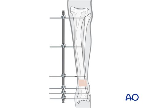 General Considerations On External Skeletal Fixators