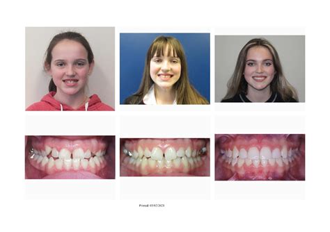 Symmetry Dental Teenage Orthodontics Before And Afters Gallery