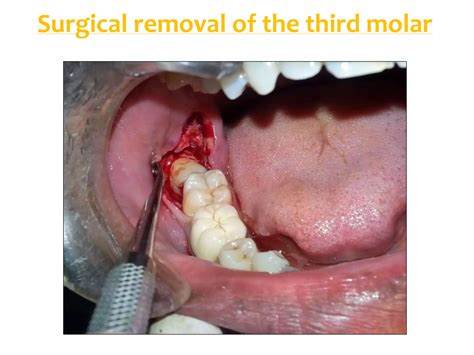 Impaction In Oral Surgery Pptx