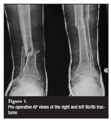 How Long Does Tetanus Take To Develop