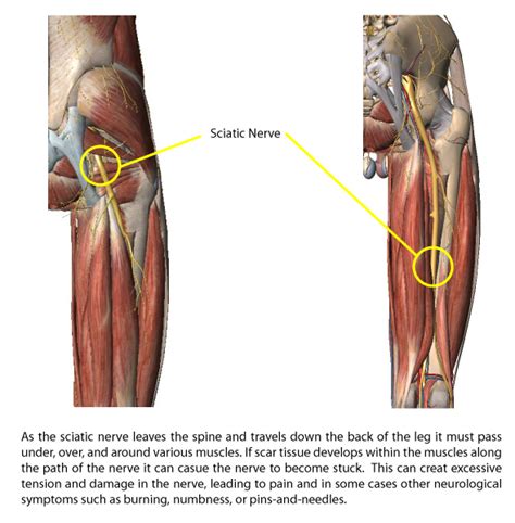 Hamstring Nerve Pain At Tammy Teague Blog