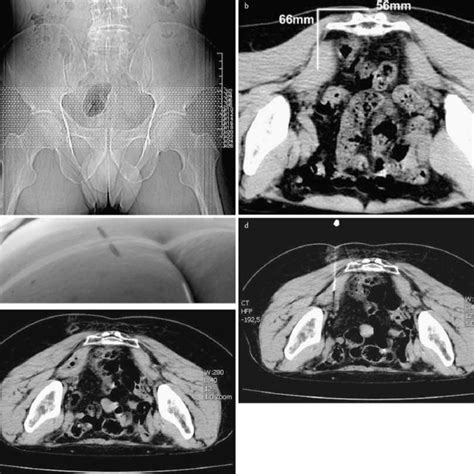 Pdf Das Piriformis Syndrom Diagnostik Und Therapie