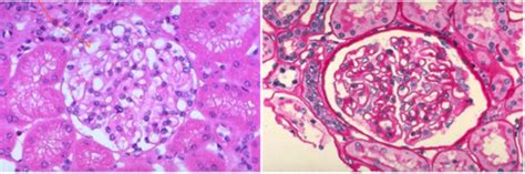 Pathogenesis Of Glomerular Injury Flashcards Quizlet